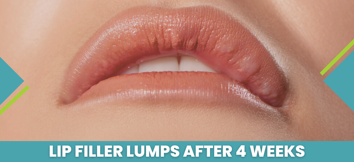 Are Small Lumps Normal After Lip Fillers In India - Infoupdate.org